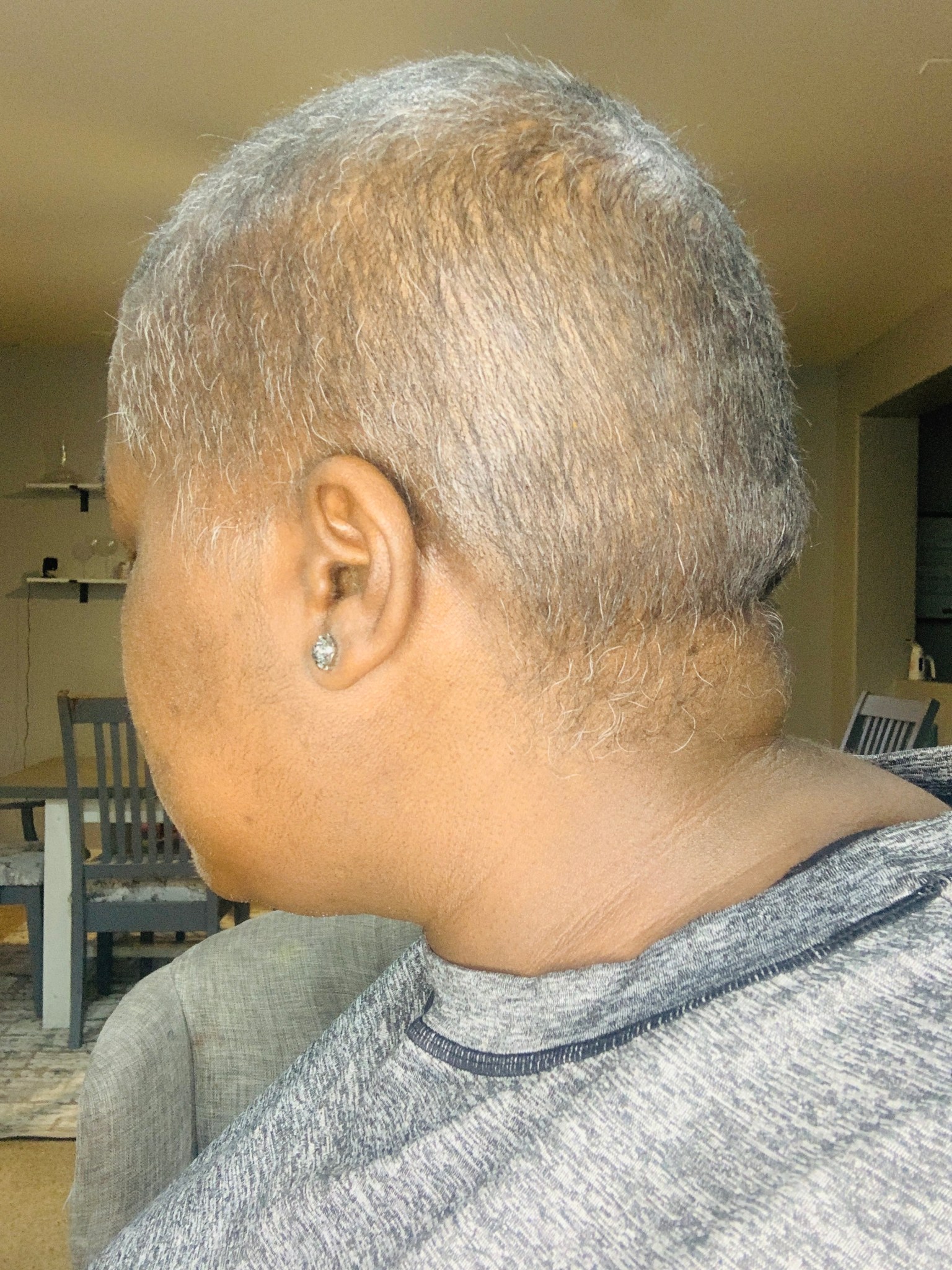 03-Triple Negative Breast Cancer – Metaplastic – Update & Hair Loss ...