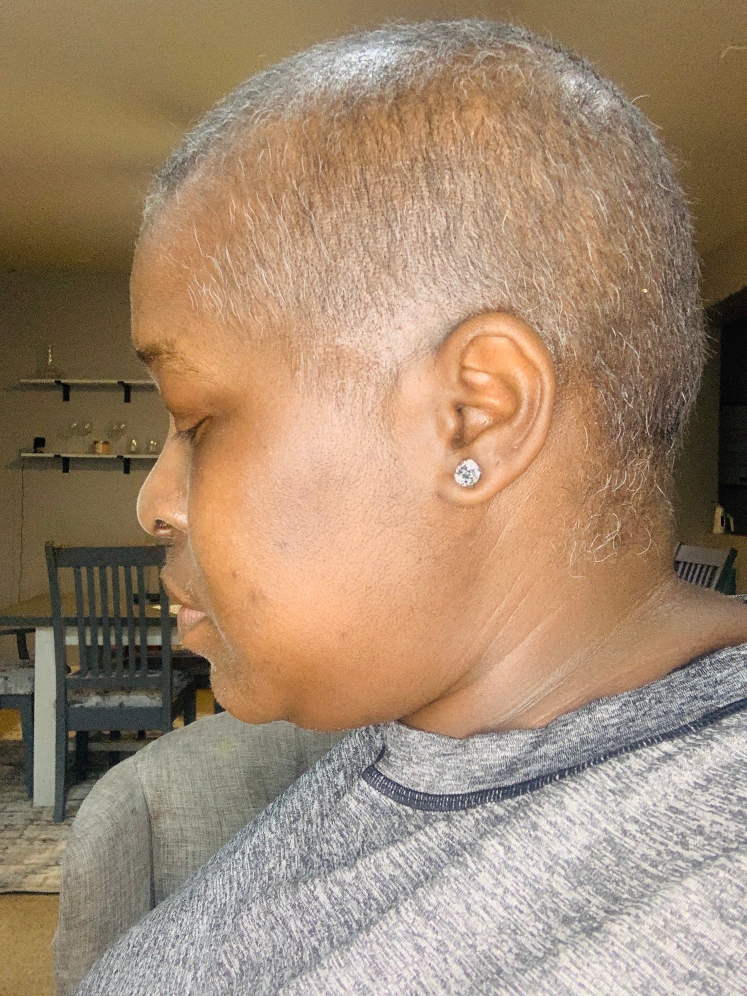 03-Triple Negative Breast Cancer – Metaplastic – Update & Hair Loss ...