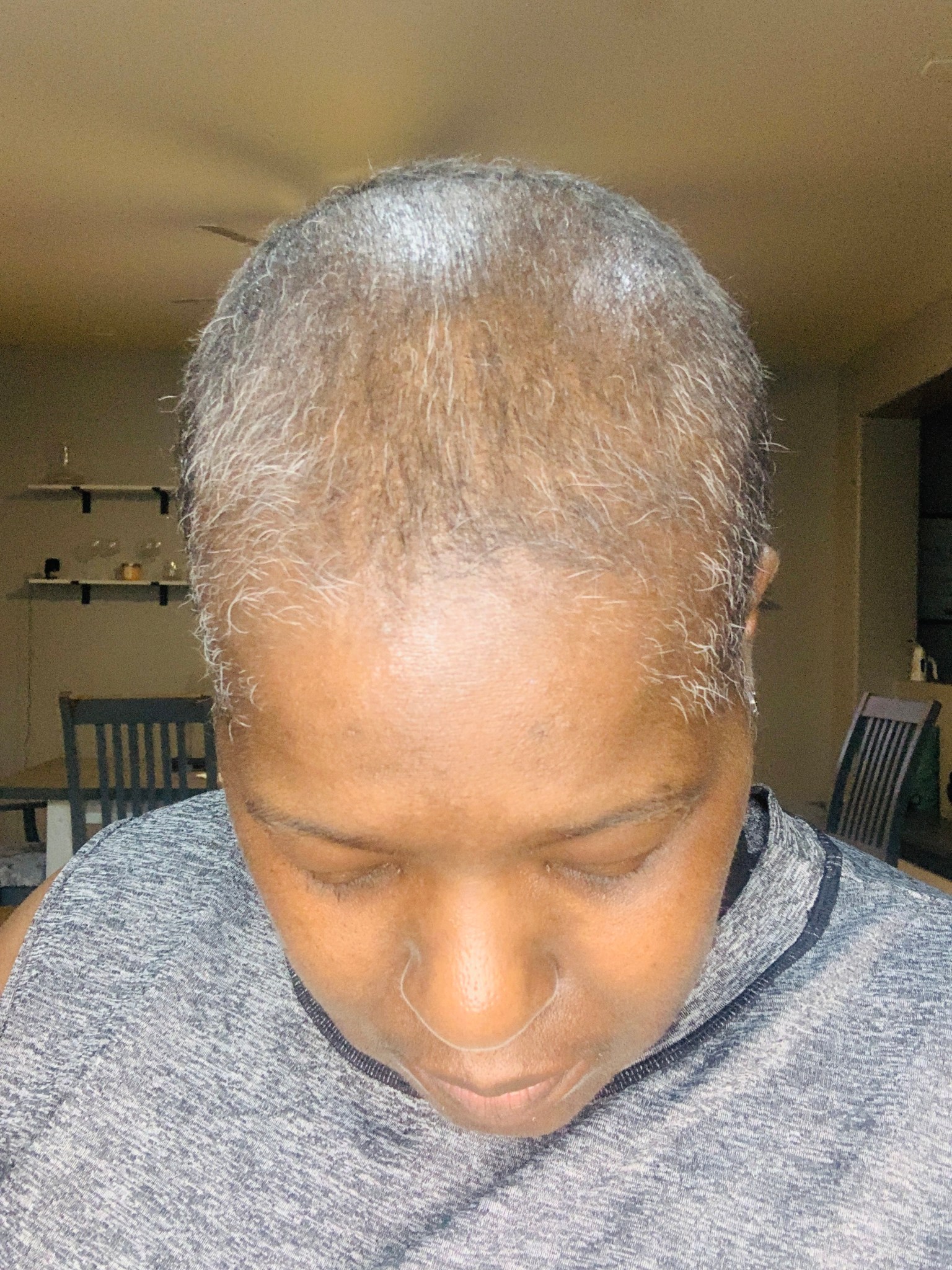 03-Triple Negative Breast Cancer – Metaplastic – Update & Hair Loss ...
